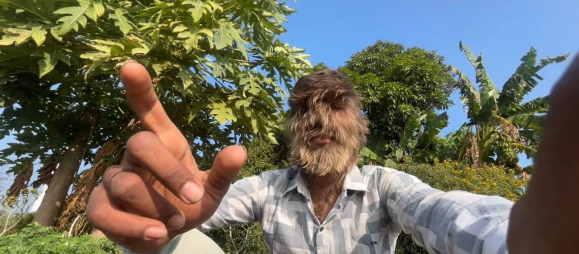 Lalit Patidar: 6 Fun Facts About The Man With The Hariest Face In The ...